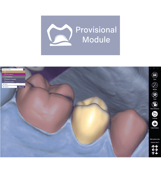 Exocad Software: Implant Package Provisional Module